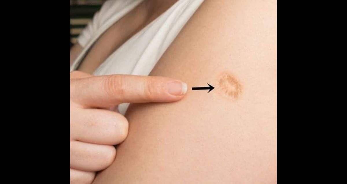 M Çiçeği dünya geneli hızla yayılırken Sağlık bakanlığından açıklama ...